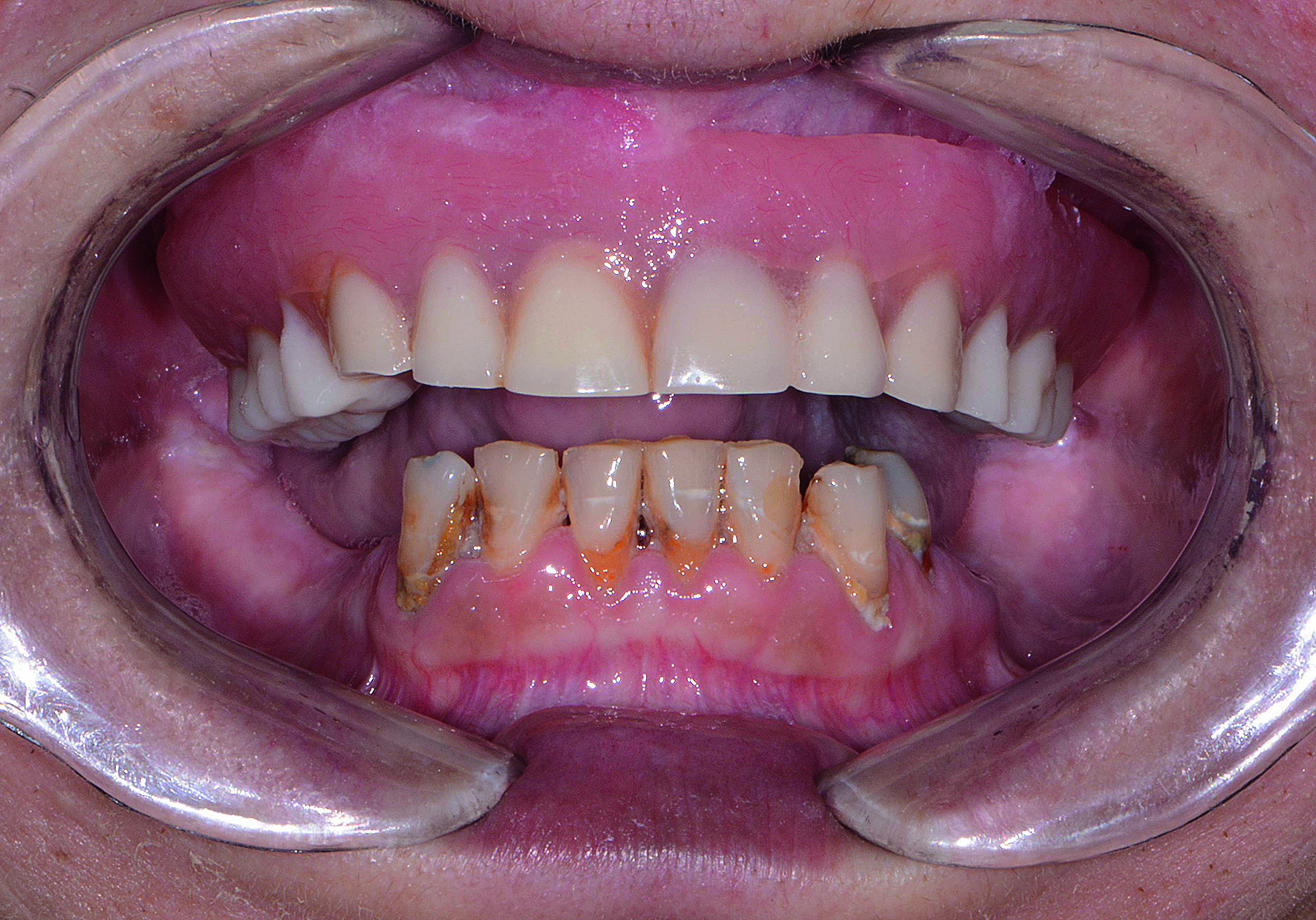 Dental News - Incorporating CAD/CAM solutions for full-mouth dental ...